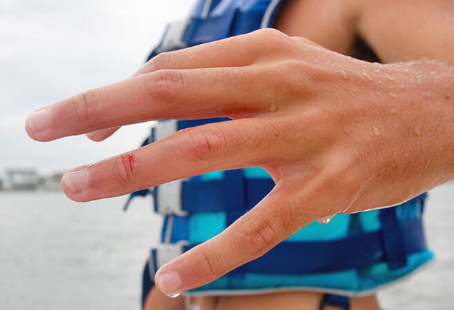 Finger Dislocation Florida Orthopaedic Institute Finger Dislocation Florida Orthopaedic Institute