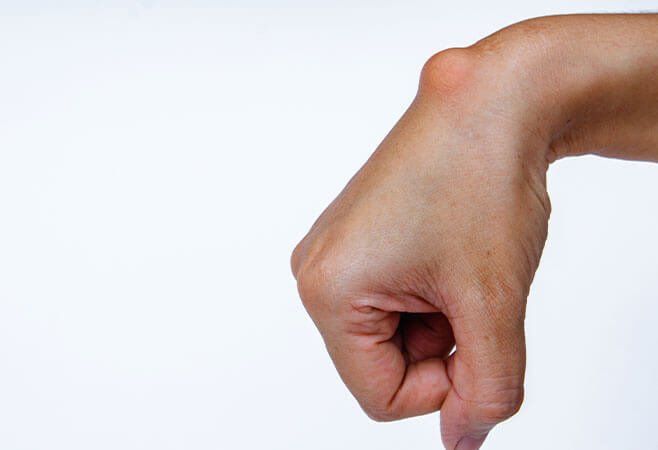 Ganglion Cyst Wrist