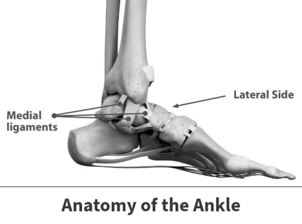 Sprained Ankle | Turned Ankle | Florida Orthopedics
