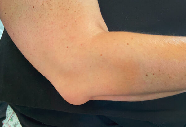Bursitis of the Elbow | Florida Orthopaedic Institute