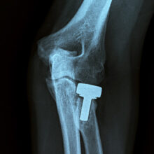 Elbow Pain Treatment Specialists | Florida Orthopedics