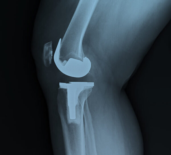 Joint Replacement | Florida Orthopaedic Institute