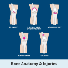 Swollen Knee | Florida Orthopaedic Institute