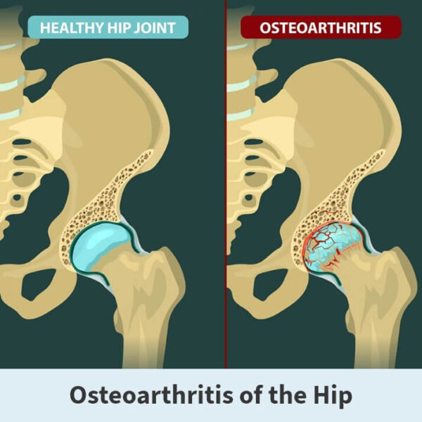Osteoarthritis of the Hip | Florida Orthopaedic Institute